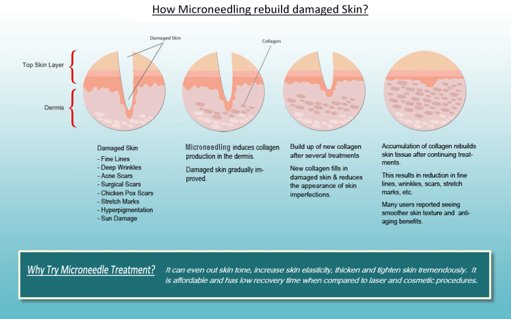 Stretch Marks Treatments – WESTON HCG CENTER